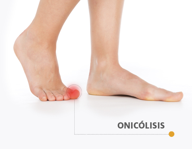 Onicólisis en los pies | Tratamiento de la onicólisis | dePie Clí­nicas
